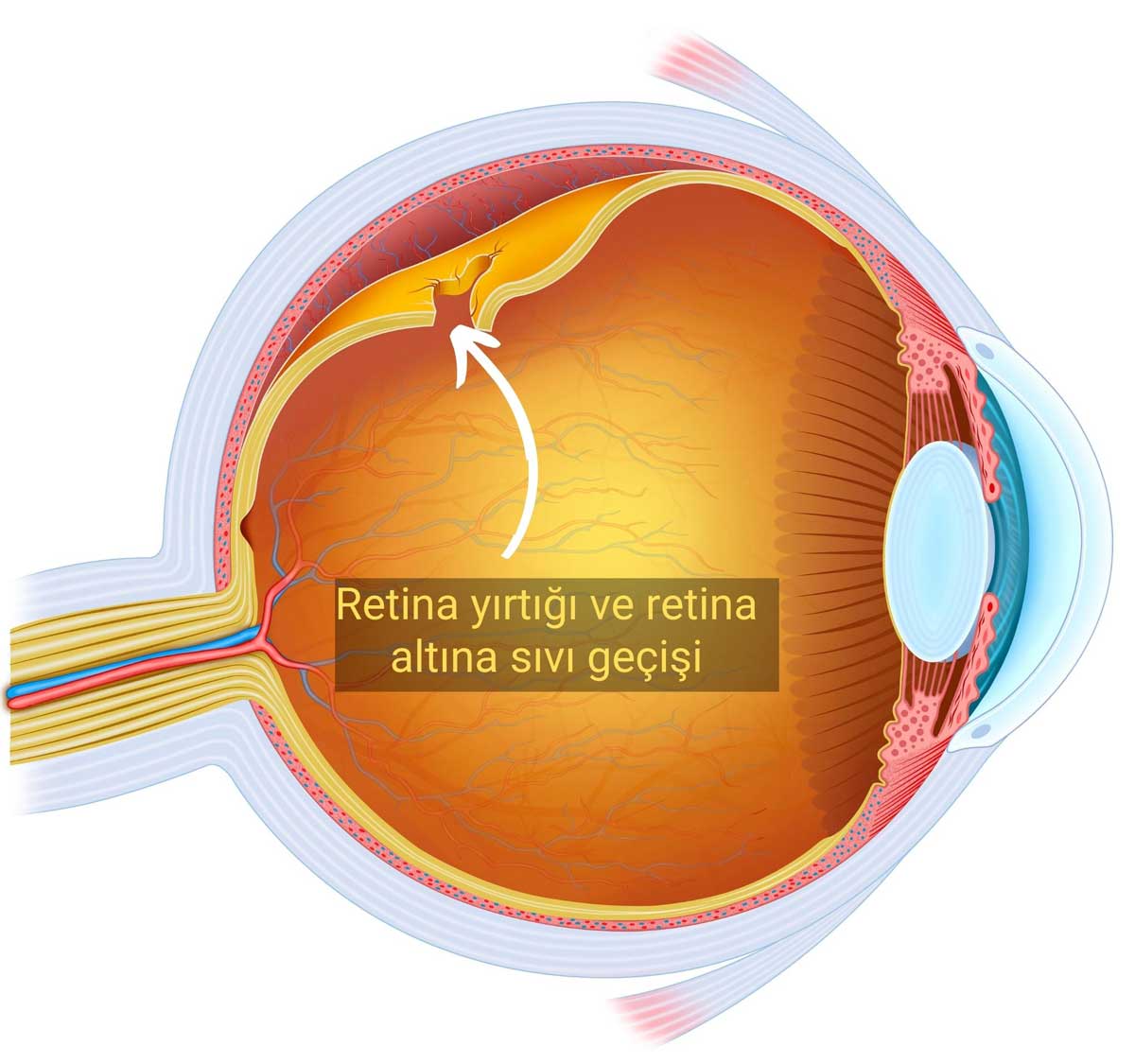 Retina Dekolmanı Nedir? Çeşitleri Nelerdir? Nasıl Tedavi Edilir? – GLJY